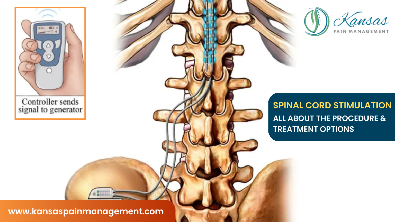 What is spinal cord stimulation?