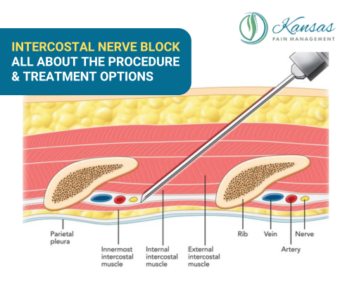Intercostal Nerve Block: Procedure & Treatment Options