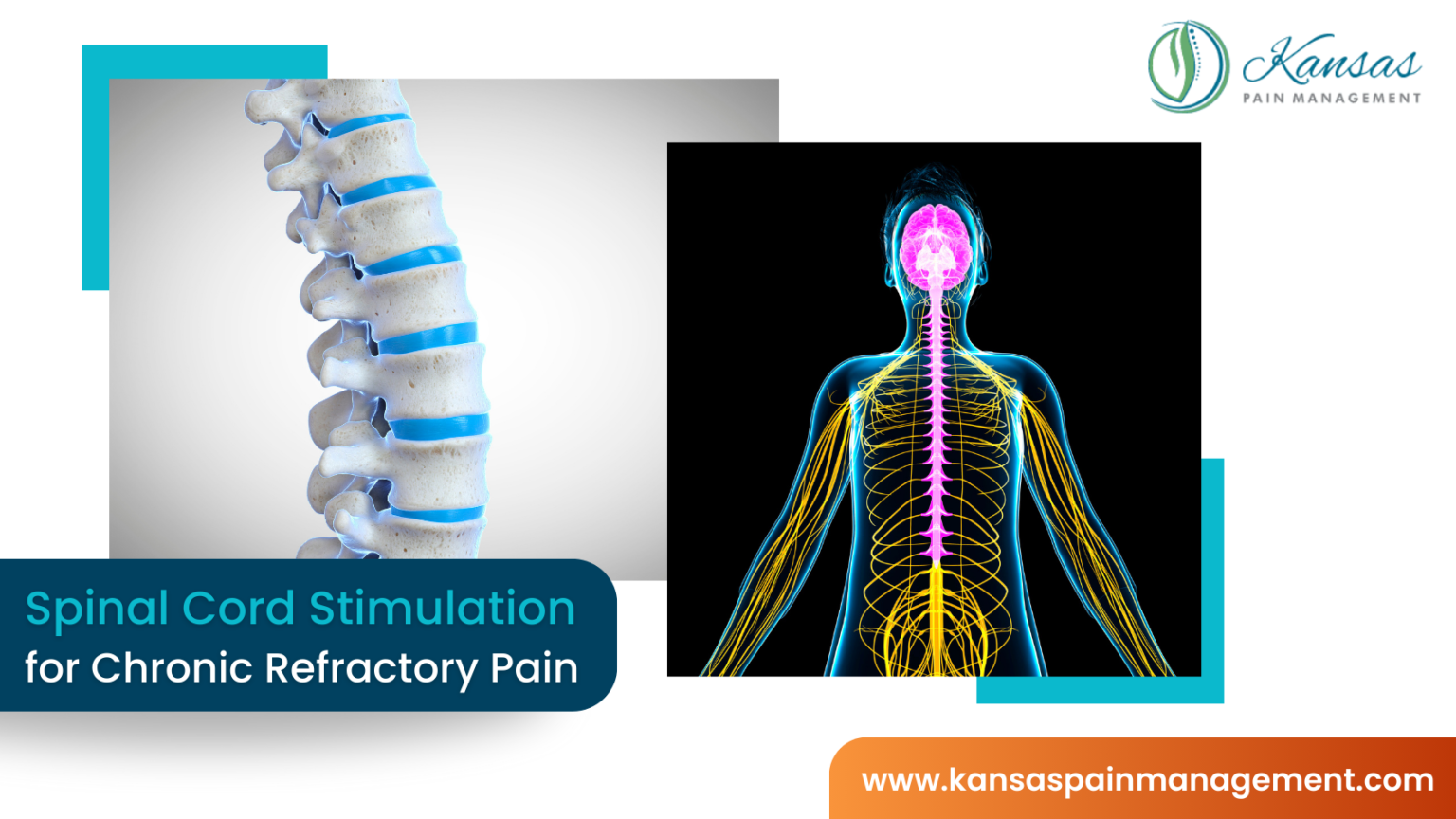 Health-Care Utilization and Outcomes with 10 kHz Spinal Cord ...