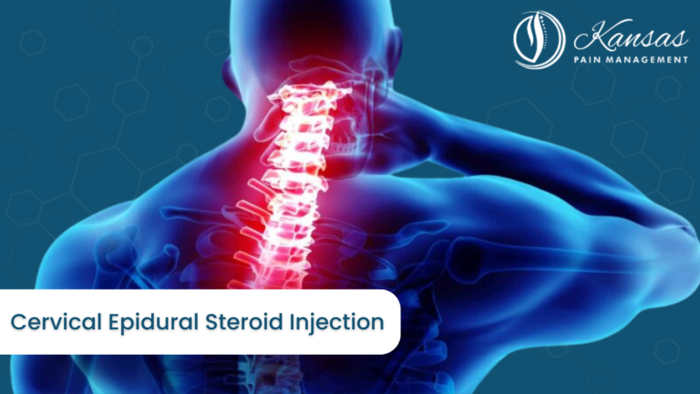 cervical-epidural-steroid-injection