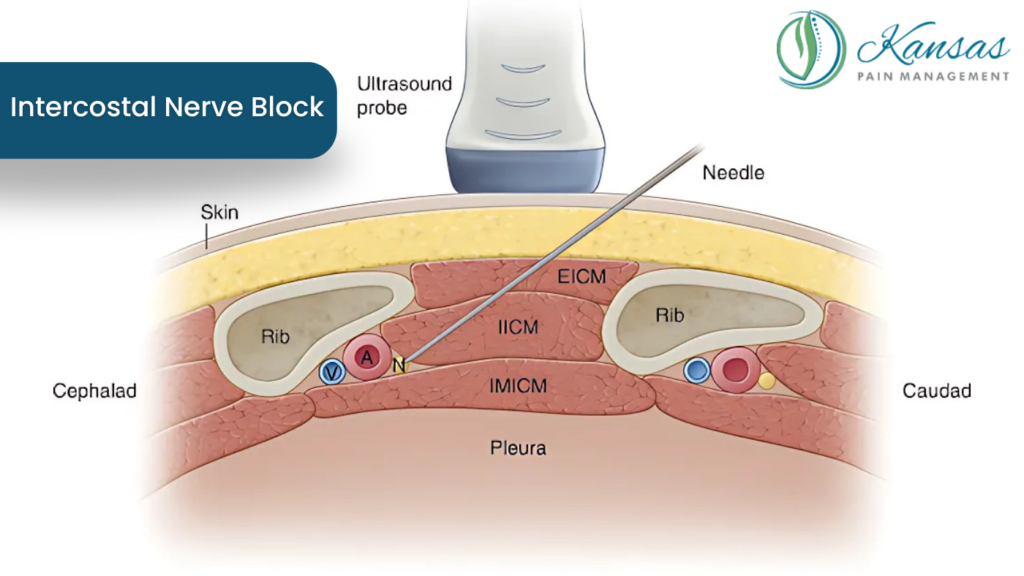 Intercostal Nerve Block Treatment in Kansas City