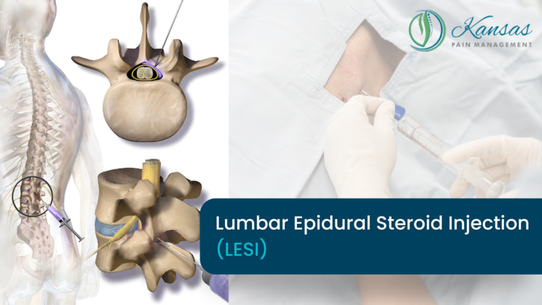 Lumbar Epidural Spinal Injection in Kansas- LESI Injection