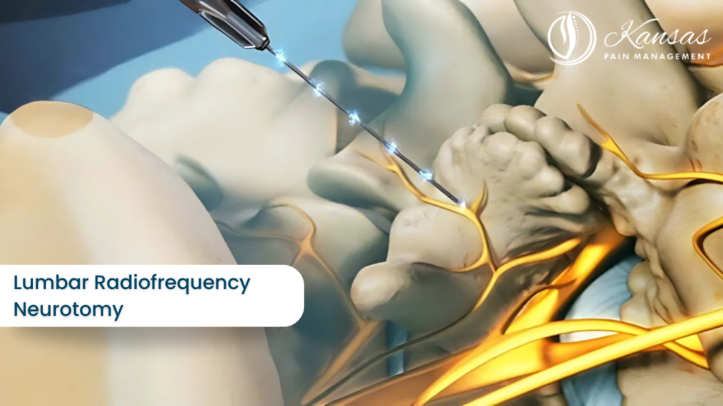 Lumbar Radiofrequency Neurotomy | Kansas Pain Management | Kansas City