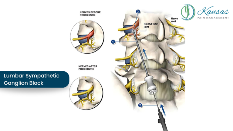 Lumbar Sympathetic Ganglion Block in Kansas City