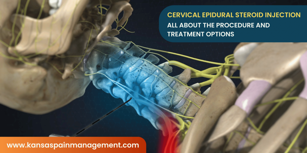 Cervical Epidural Steroid Injection (CESI)