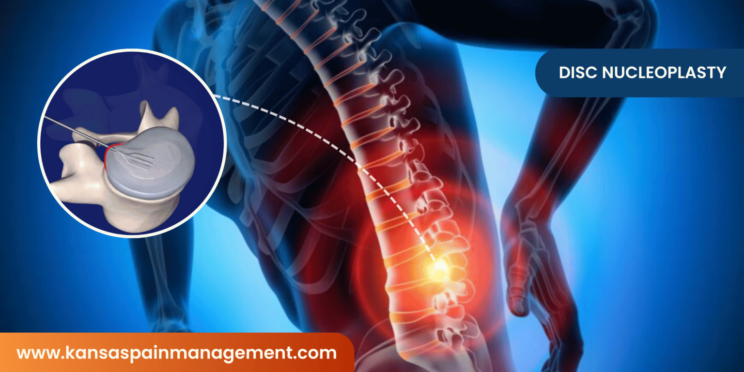 Disc Nucleoplasty in Kansas City | Kansas Pain Management