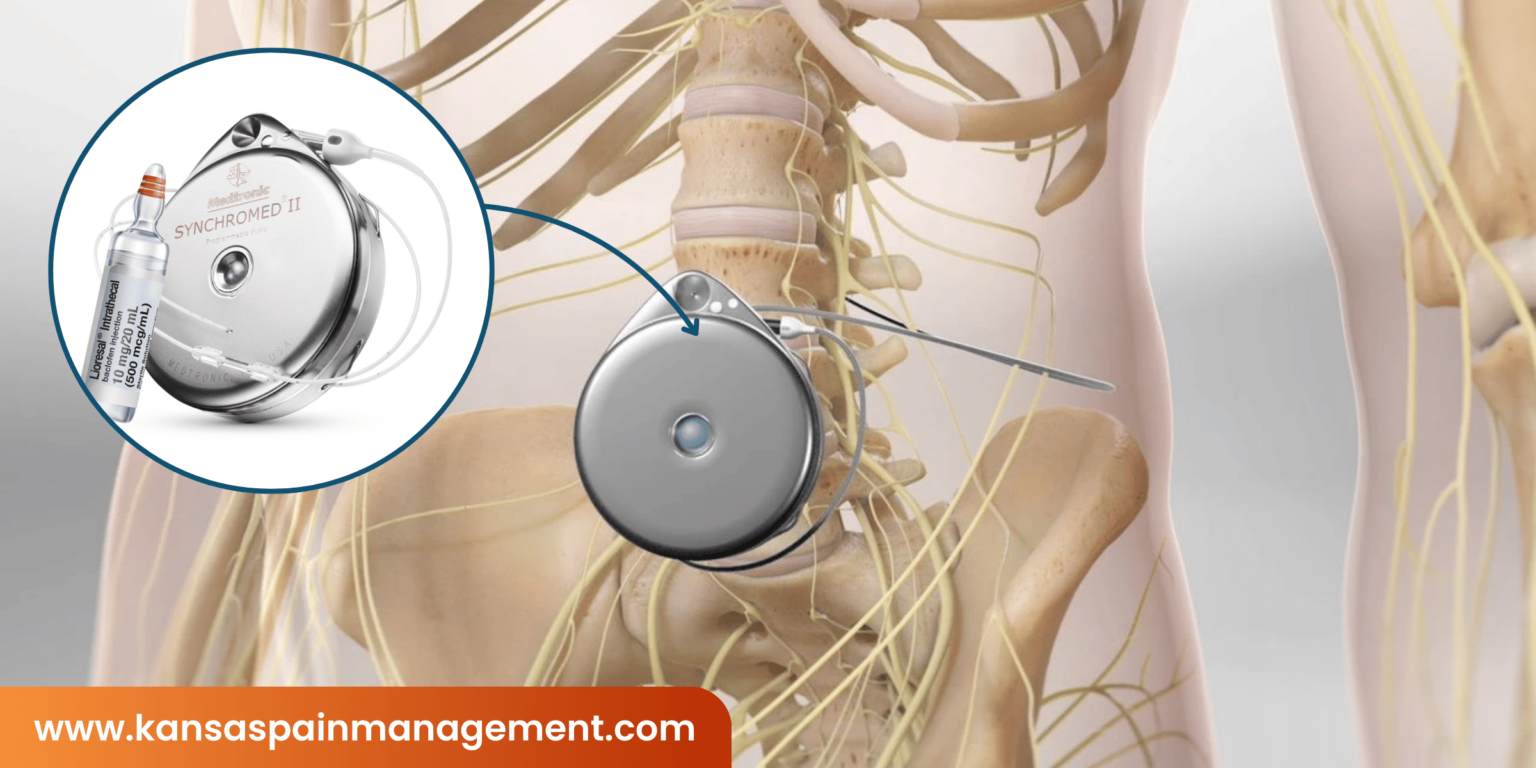 Intrathecal Pain Pump Doctors in Kansas City MO