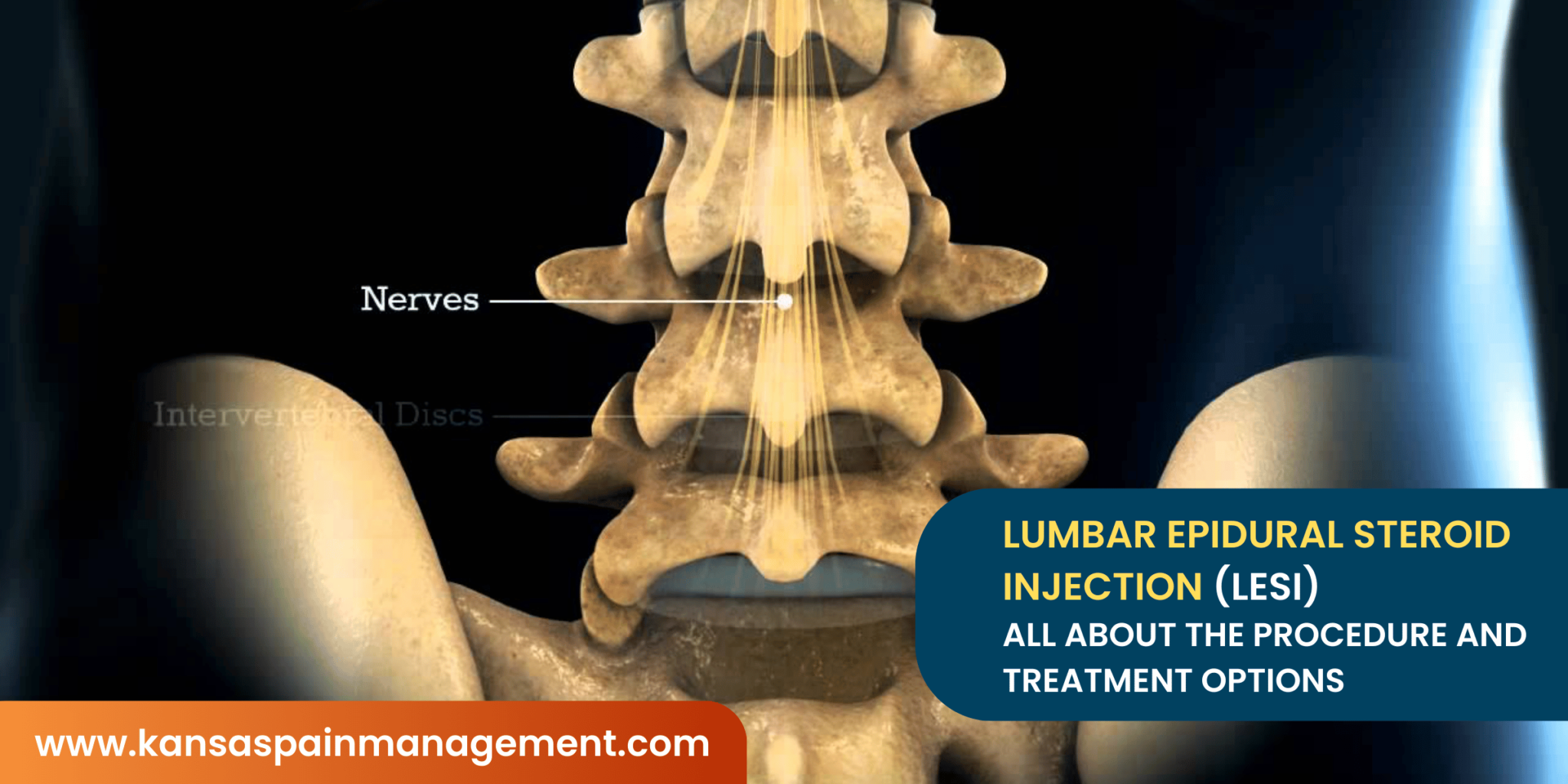 Lumbar Epidural Steroid Injection in Kansas- LESI Injection