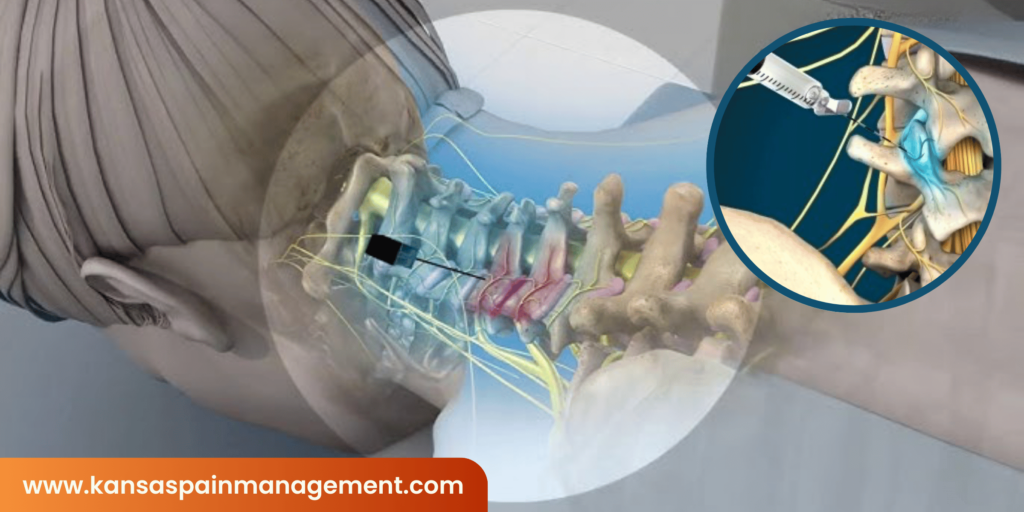 Medial Branch Block (MBB) in Kansas City