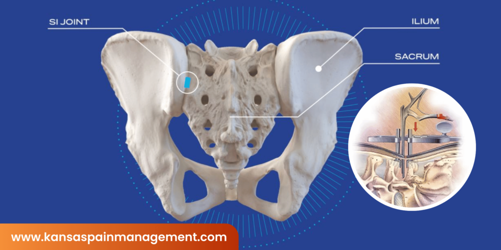 Minimally Invasive Interspinous Interlaminar Fusion in Kansas City
