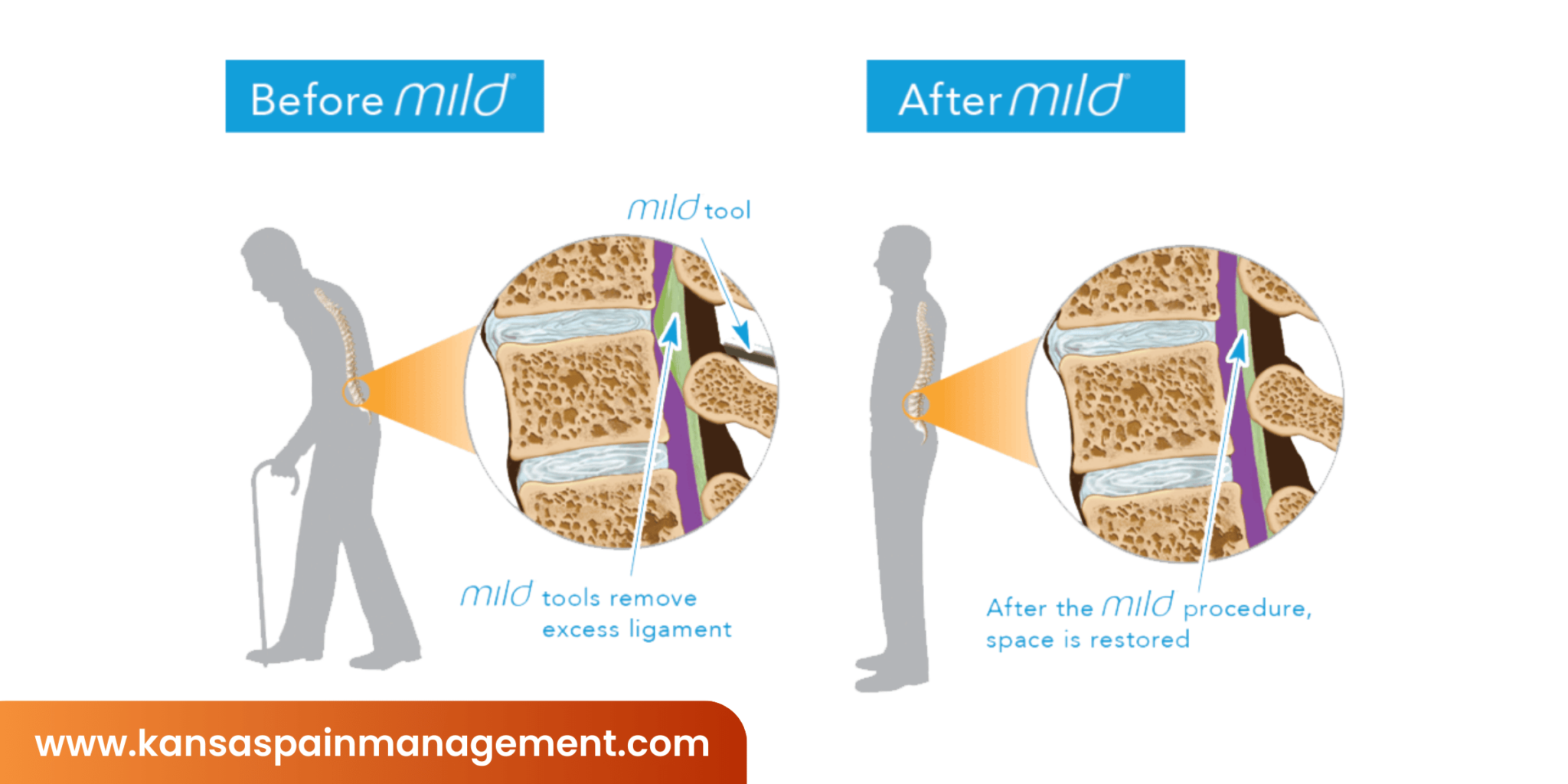 Minimally Invasive Lumbar Decompression in Kansas City