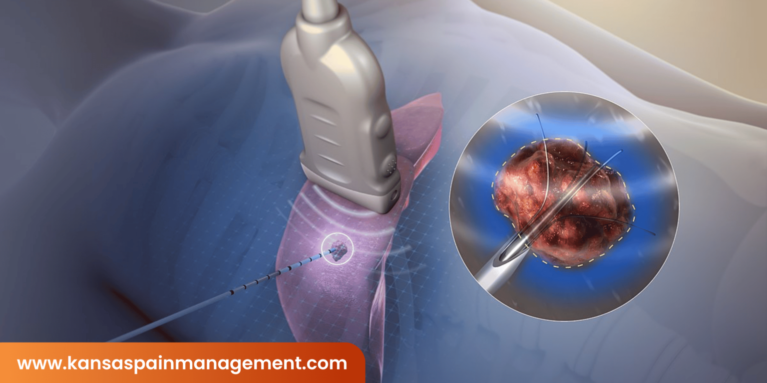 Radiofrequency Ablation (RFA) Treatment in Kansas City MO