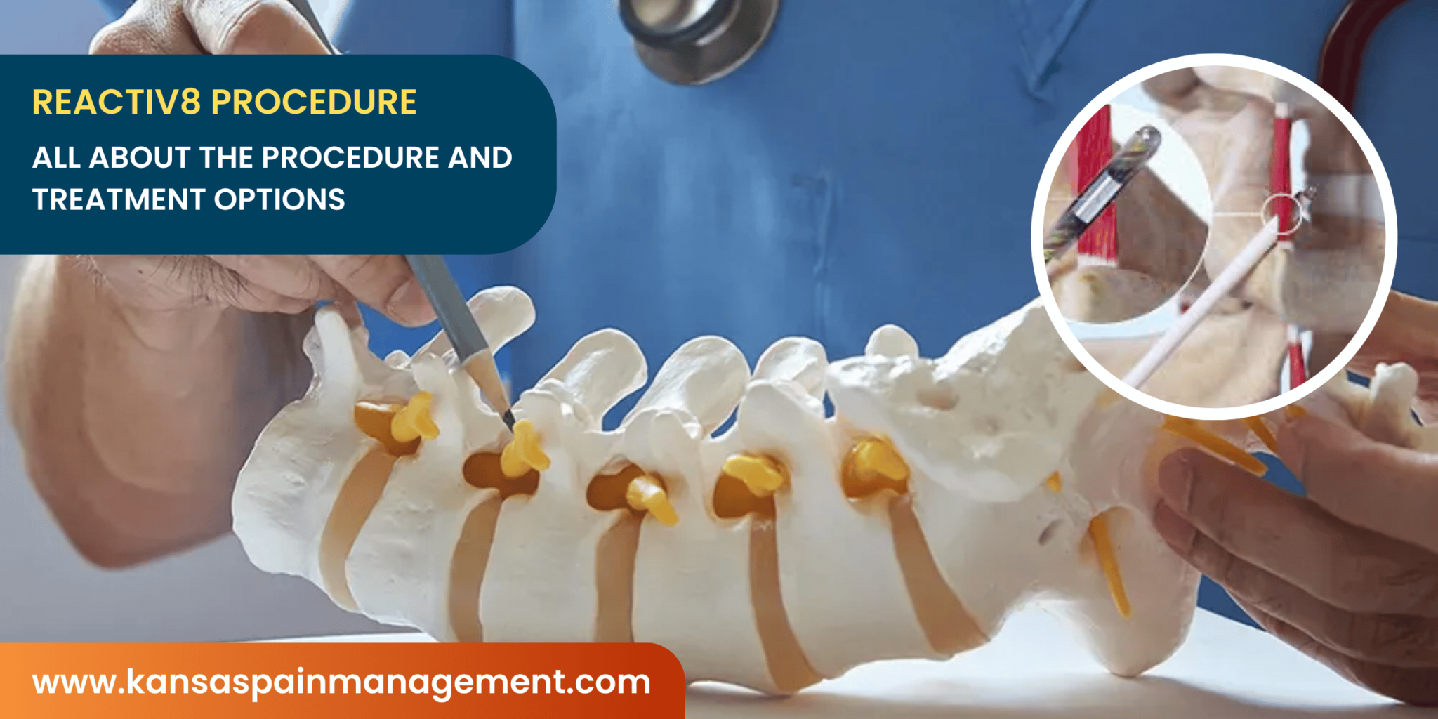 ReActiv8 Procedure | Kansas Pain Management | Kansas City