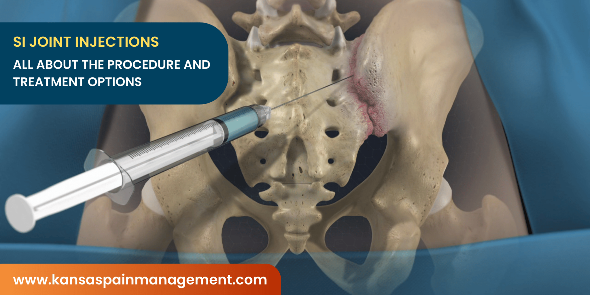 SI Joint Injections - Kansas Pain Management