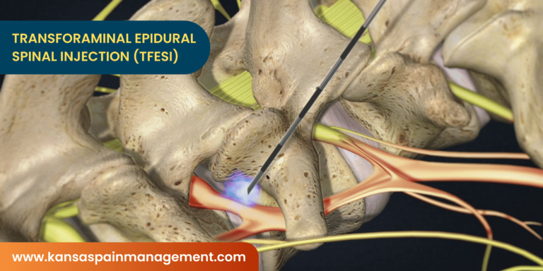Transforaminal Epidural Spinal Injection | TFESI Injection in Kansas