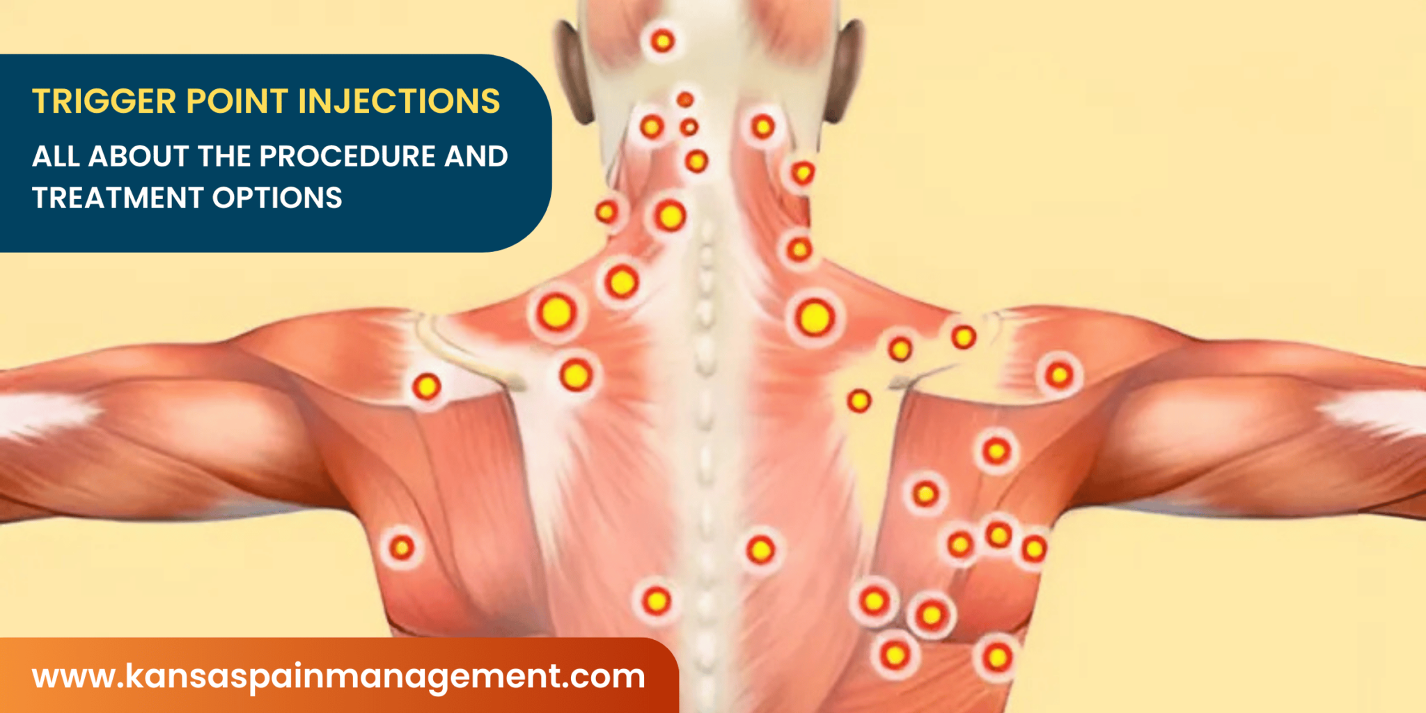 Trigger Point Injections in Kansas City - Kansas Pain Management