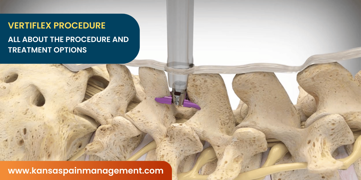 Vertiflex Procedure in Kansas City | Kansas Pain Management