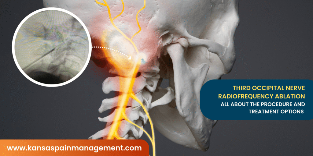 Third Occipital Nerve Radiofrequency Ablation in Kansas City