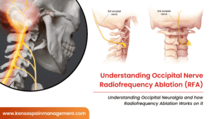 Occipital Nerve Radiofrequency Ablation (RFA)