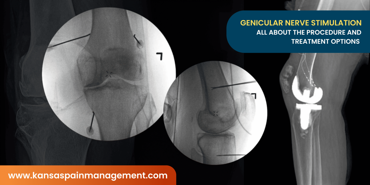 Genicular Nerve Stimulation (GNS) in Kansas City