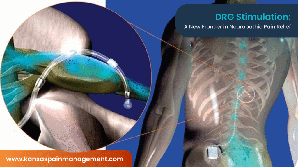DRG Stimulation: A New Frontier in Neuropathic Pain Relief