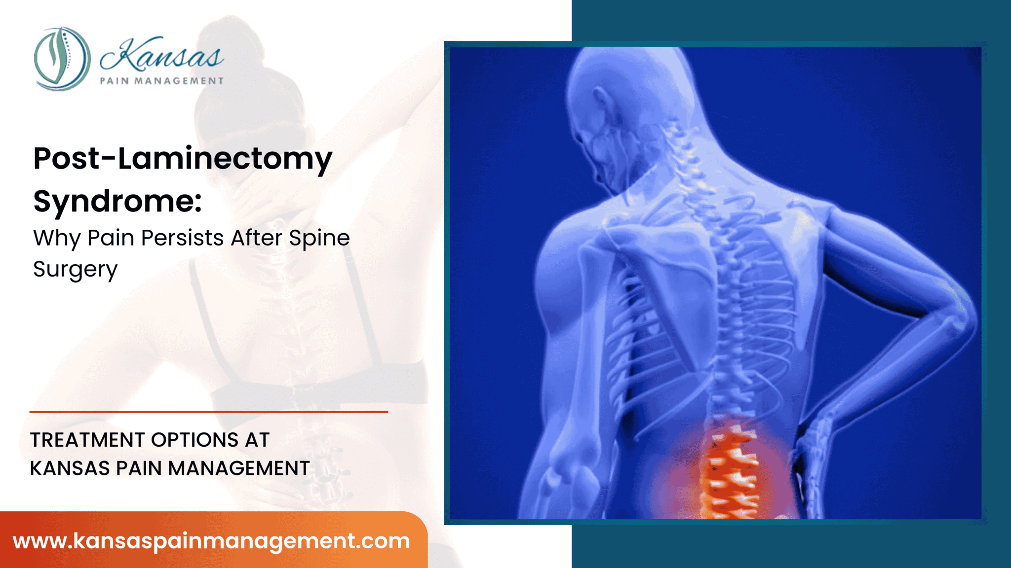 Post-Laminectomy Syndrome: Why Pain Persists After Spine Surgery