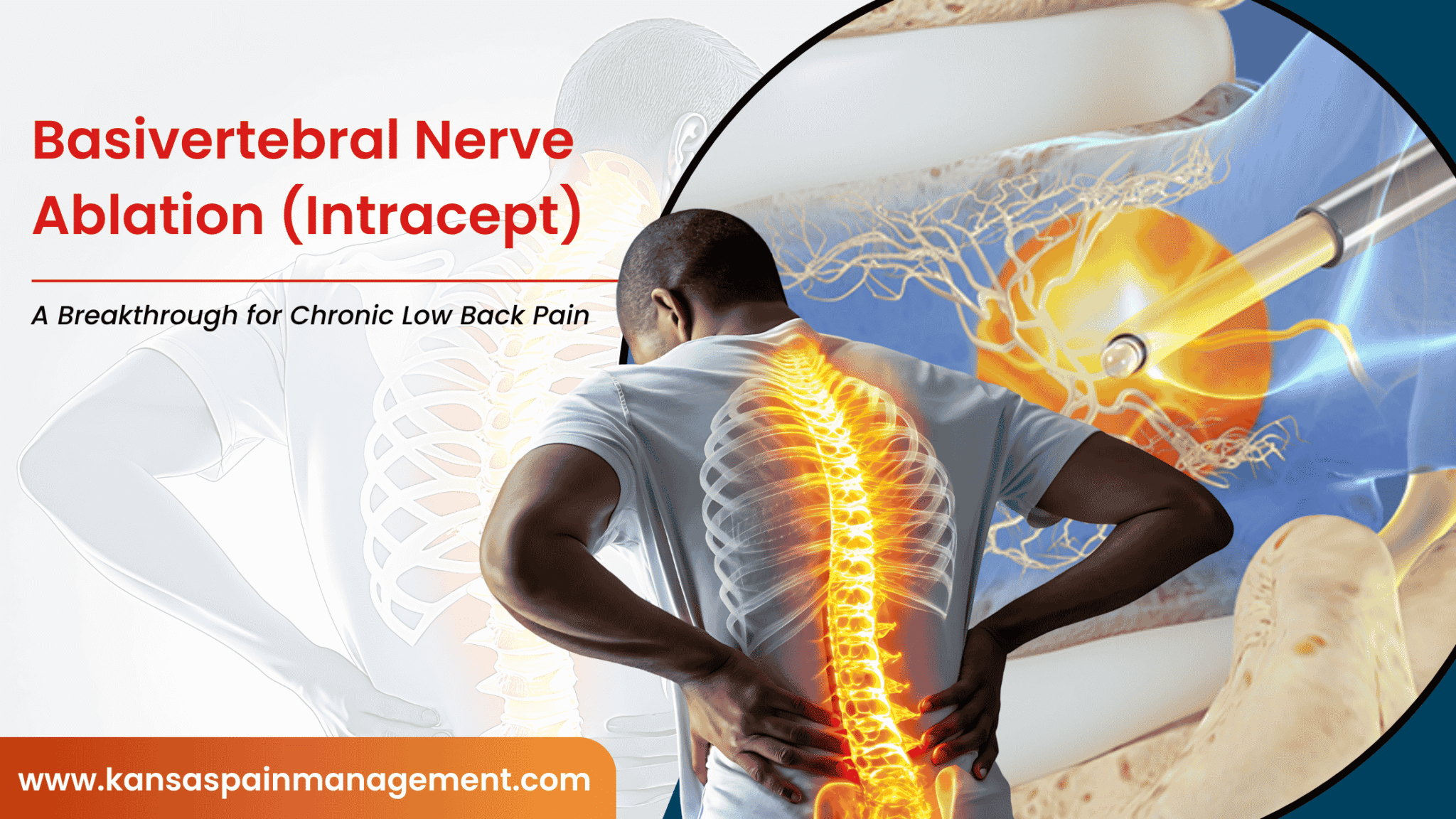 Basivertebral Nerve Ablation (Intracept): A Breakthrough for Chronic ...
