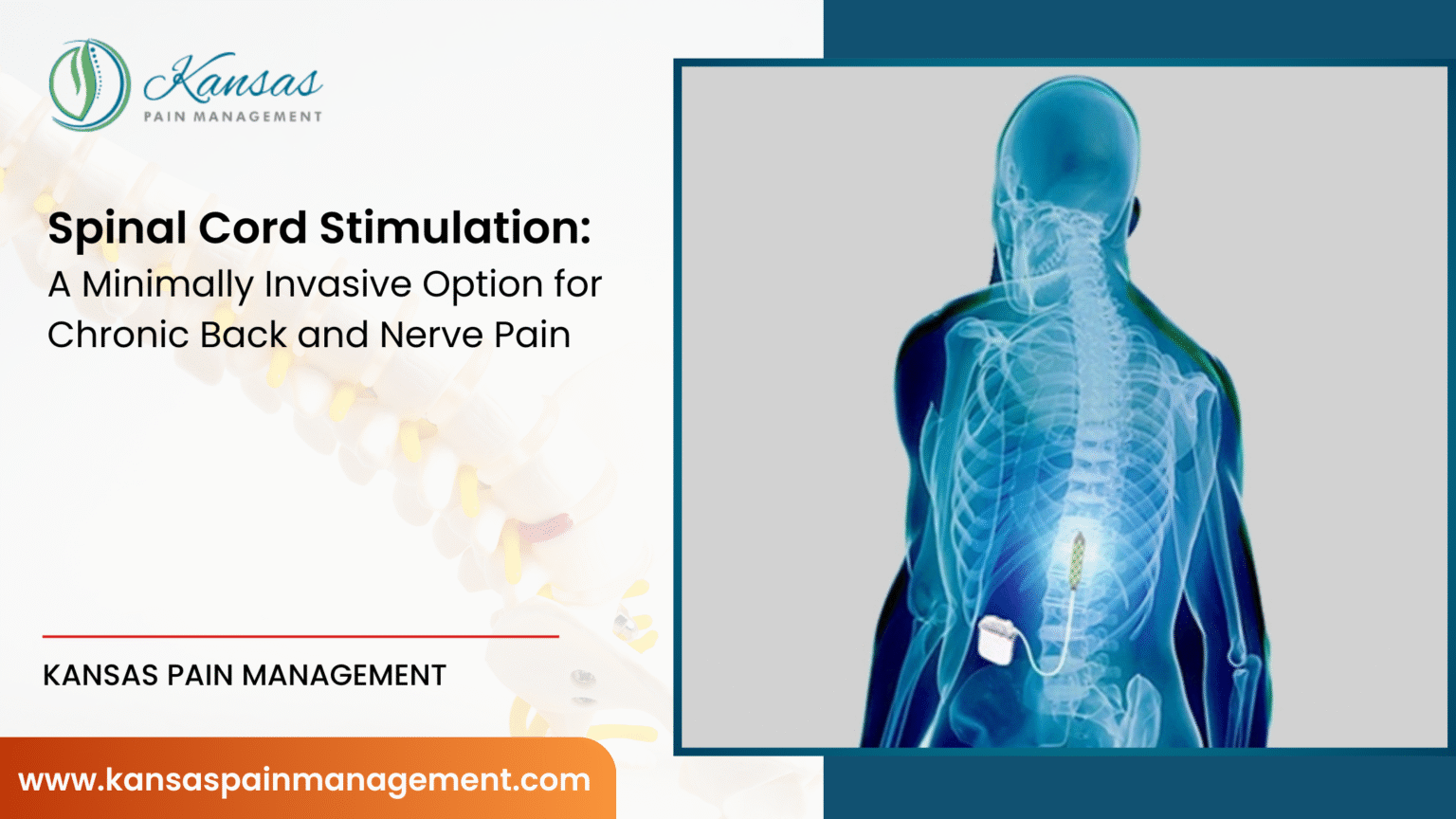 Spinal Cord Stimulation for Chronic Back & Nerve Pain